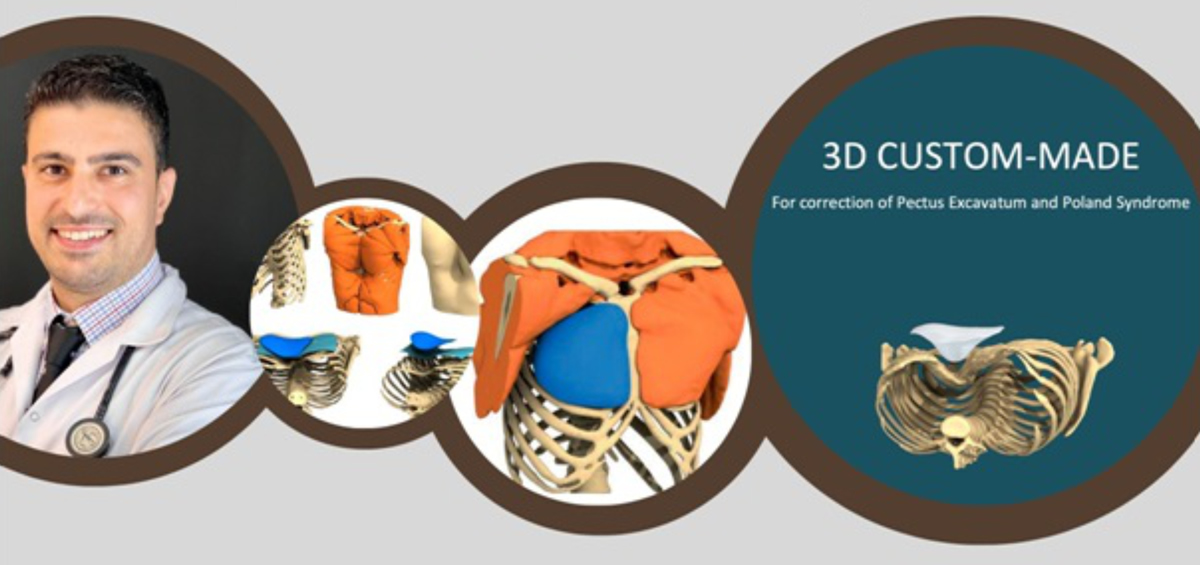 PECTUS TREATMENT WITH 3D SILICONE IMPLANT - Dr Hasan ERSÖZ